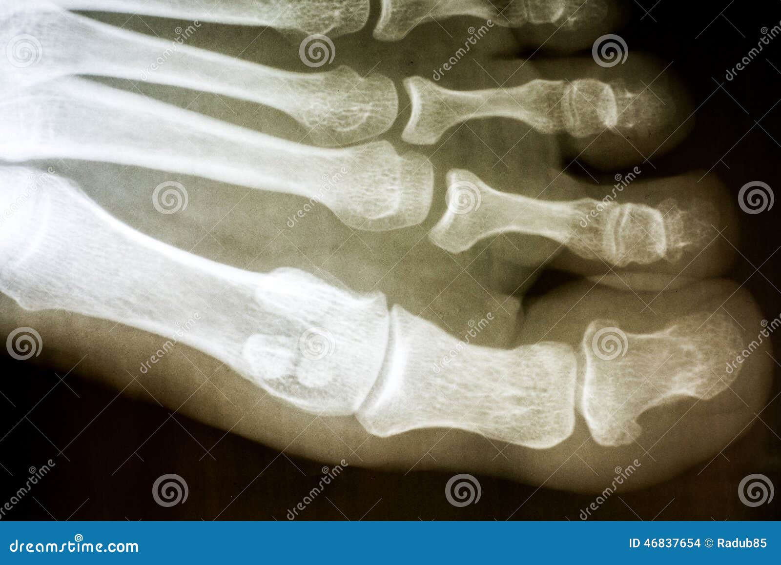 Rayon X de pied humain photo stock. Image du fuselage - 46837654