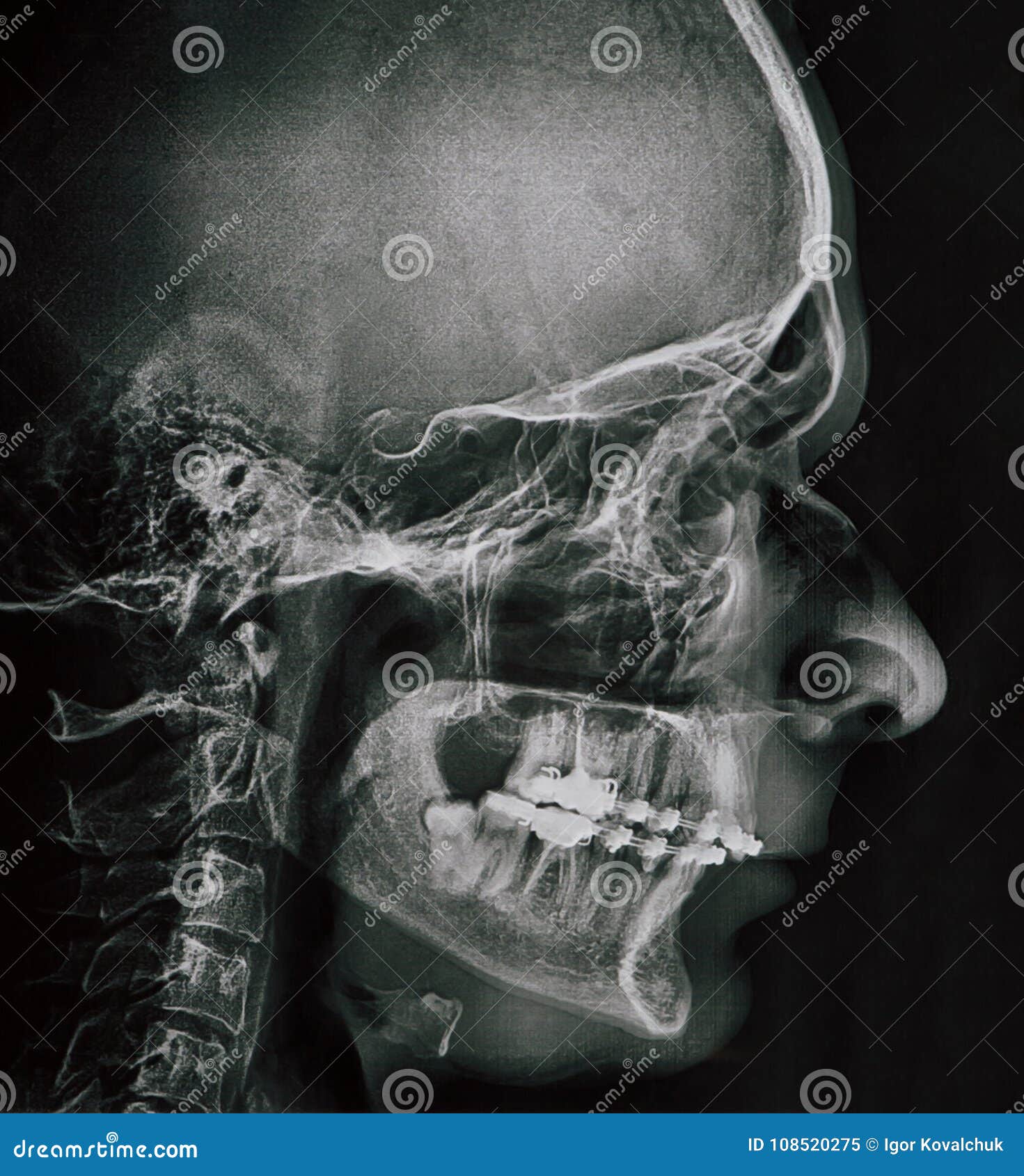 Rayon X De Profil De Mâchoire De L'homme Image stock - Image of humain ...