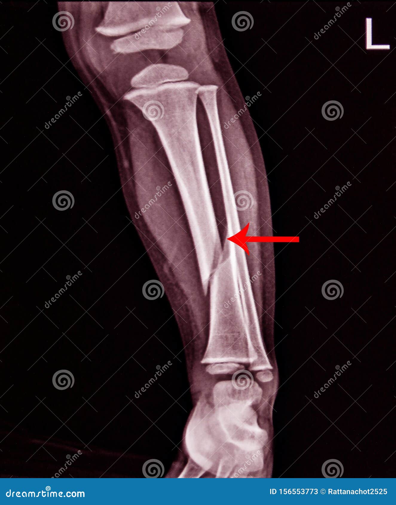 Rayon De Rayons X Jambe Gauche AP Lat Fracture Tibia Image stock ...