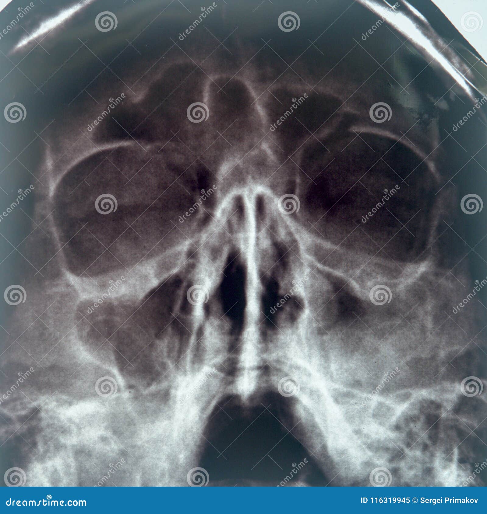 Rayon X des sinus du nez image stock. Image du sinusite - 116319945