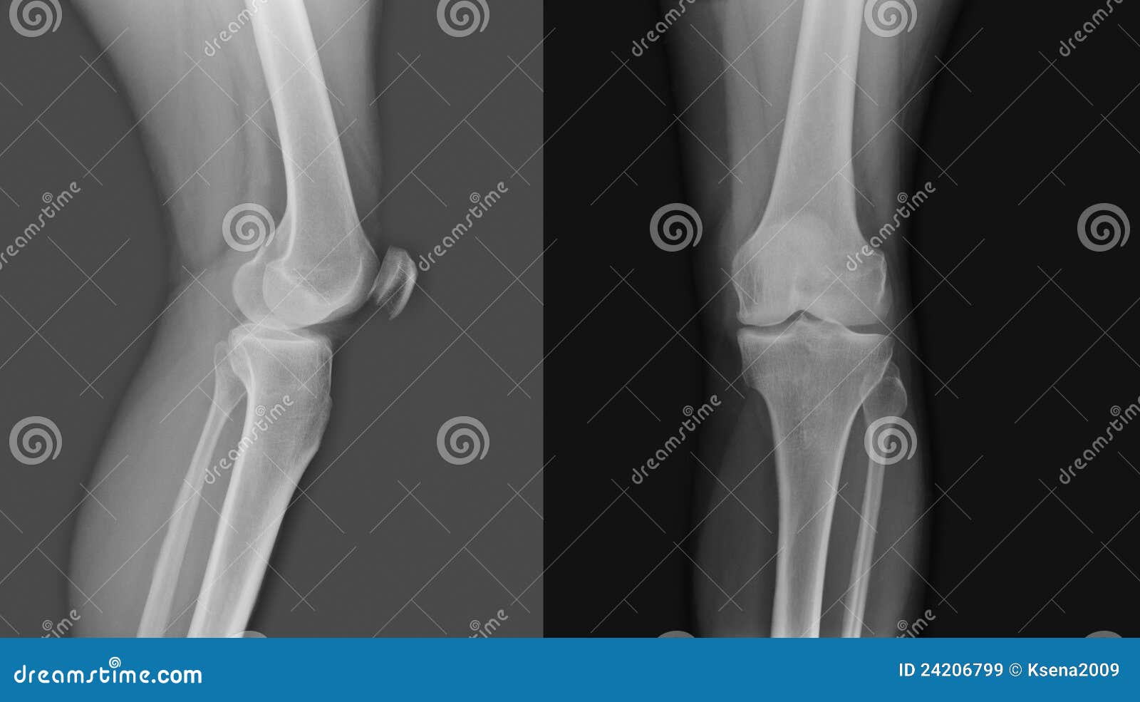 Rayon X - genou humain image stock. Image du hôpital - 24206799