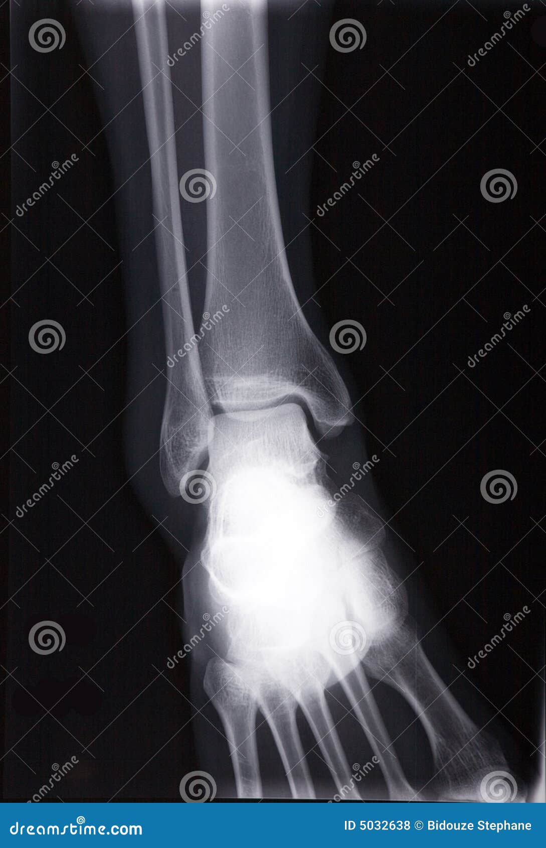 Rayon X humain de cheville photo stock. Image du guérissez - 5032638
