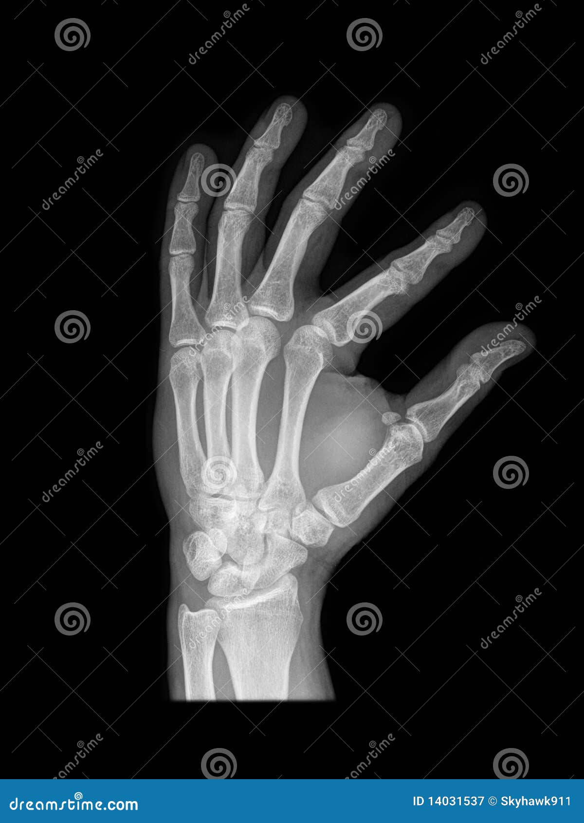 Rayon X humain de main image stock. Image du radiologiste - 14031537