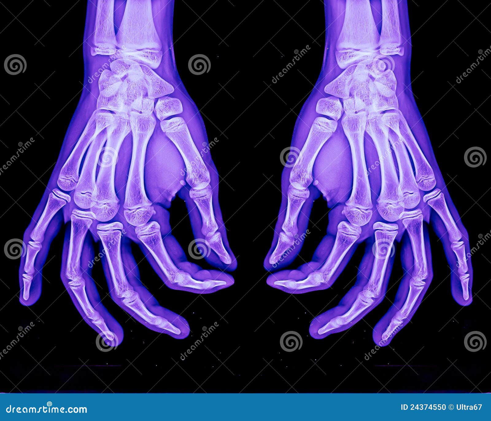 Rayon X Normal Des Deux Mains Photo stock - Image du bandeau, sport ...