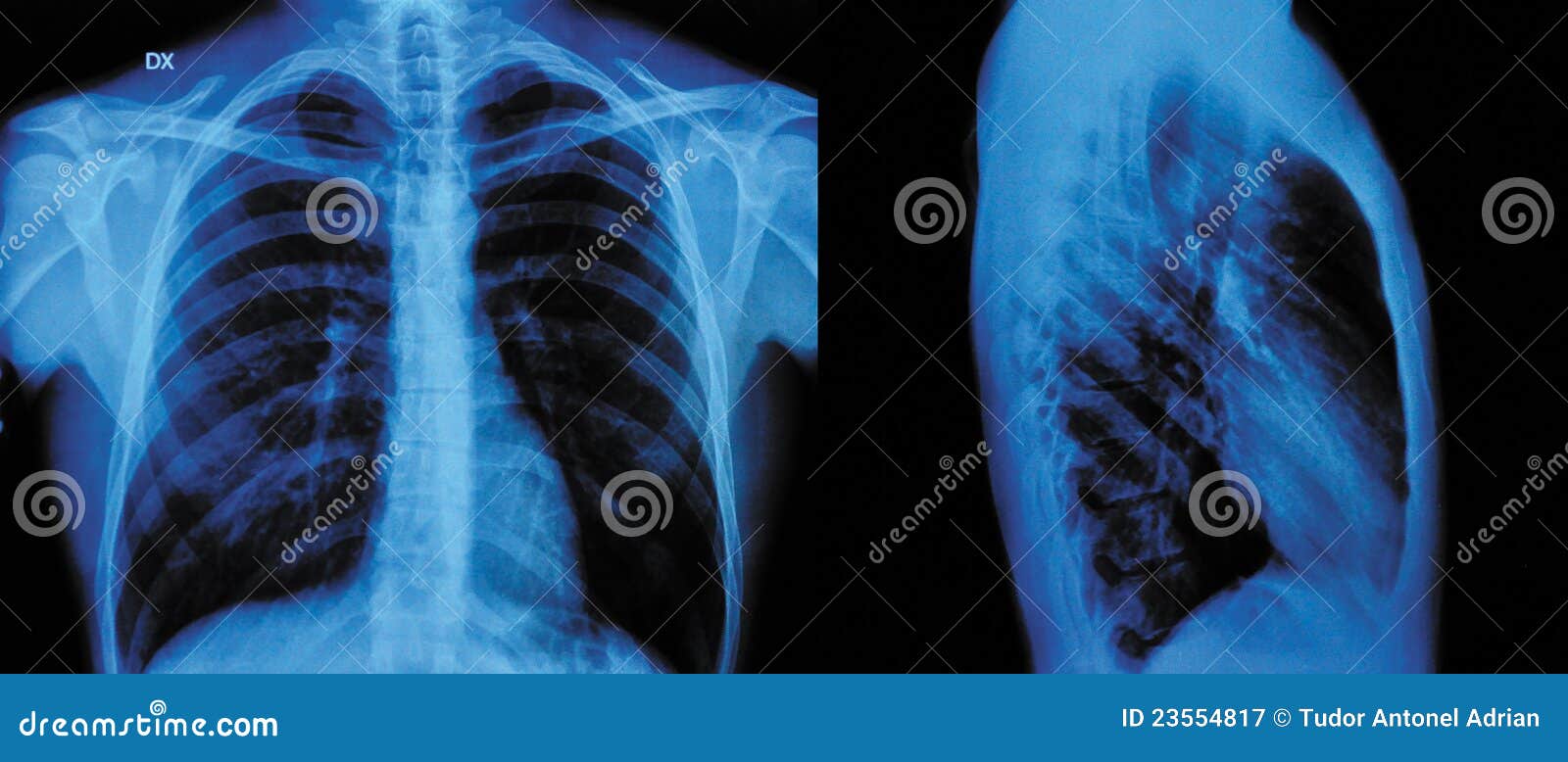 Rayon X image stock. Image du poumon, respirez, radiogramme - 23554817