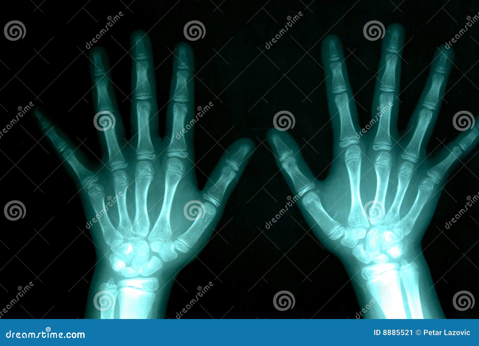 Rayon X Des Mains Image stock - Image: 8885521