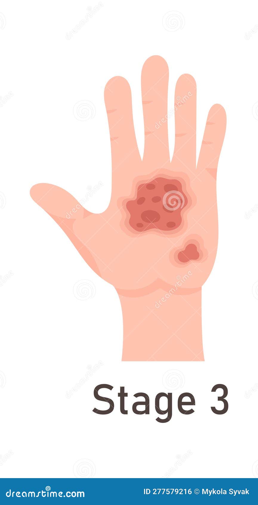3rd Degree of Skin Burn stock illustration. Illustration of feet ...