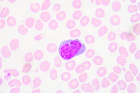 Reactive lymphocytes stock image. Image of carrier, group - 50488037