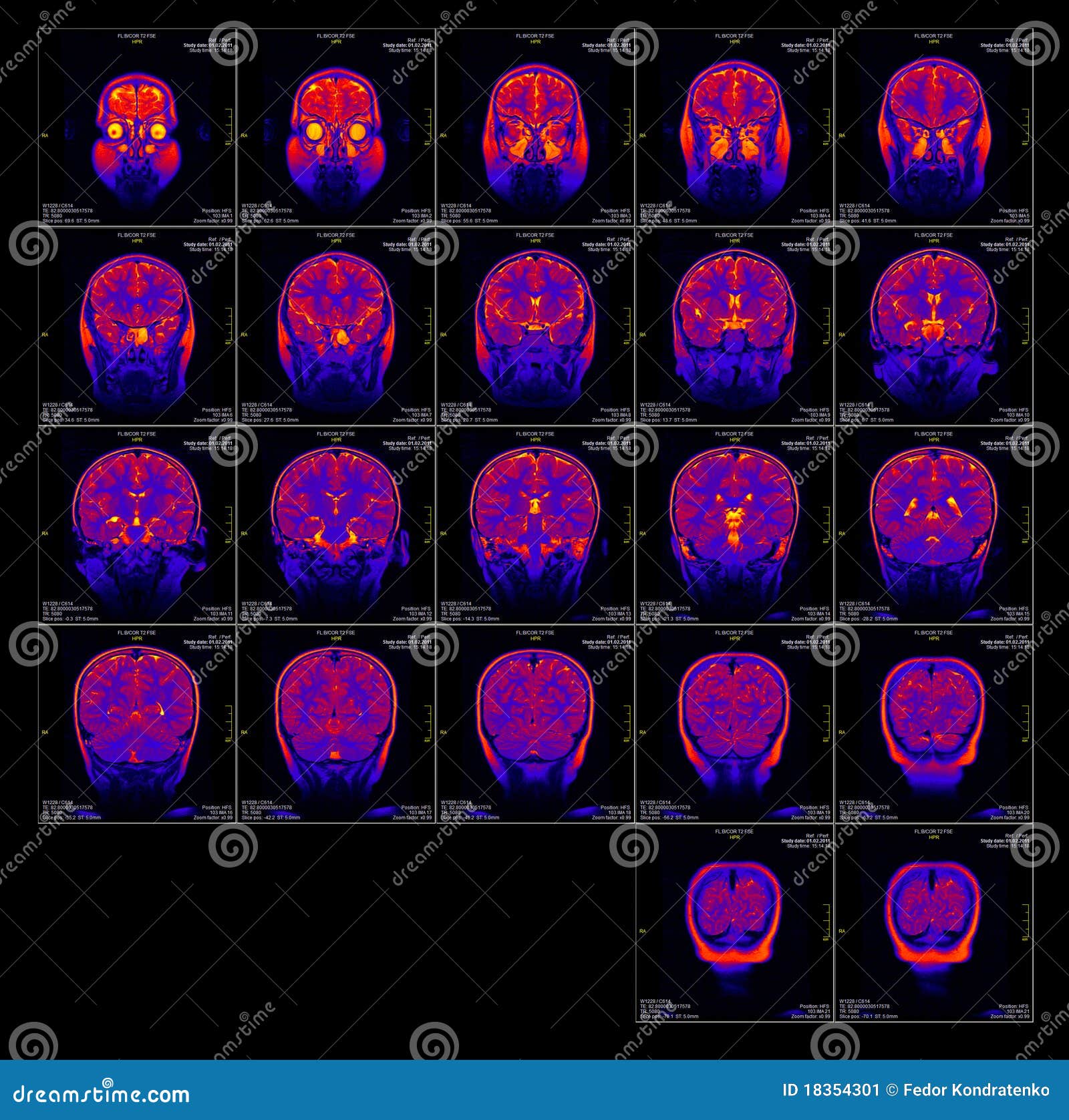 Real Brain MRI Slide of a Girl Stock Illustration - Illustration of ...
