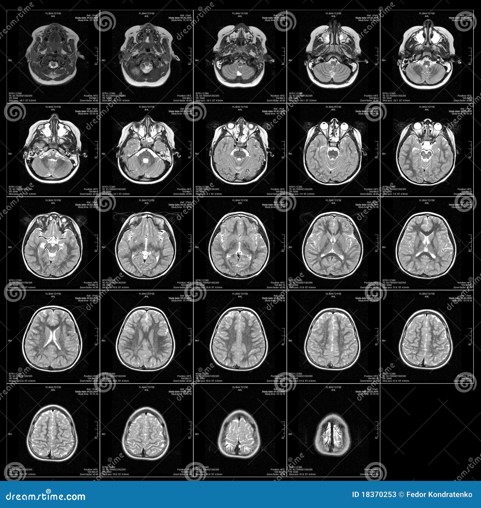 Real Brain MRI Slide of a Girl Stock Image - Image of brain, healthcare ...