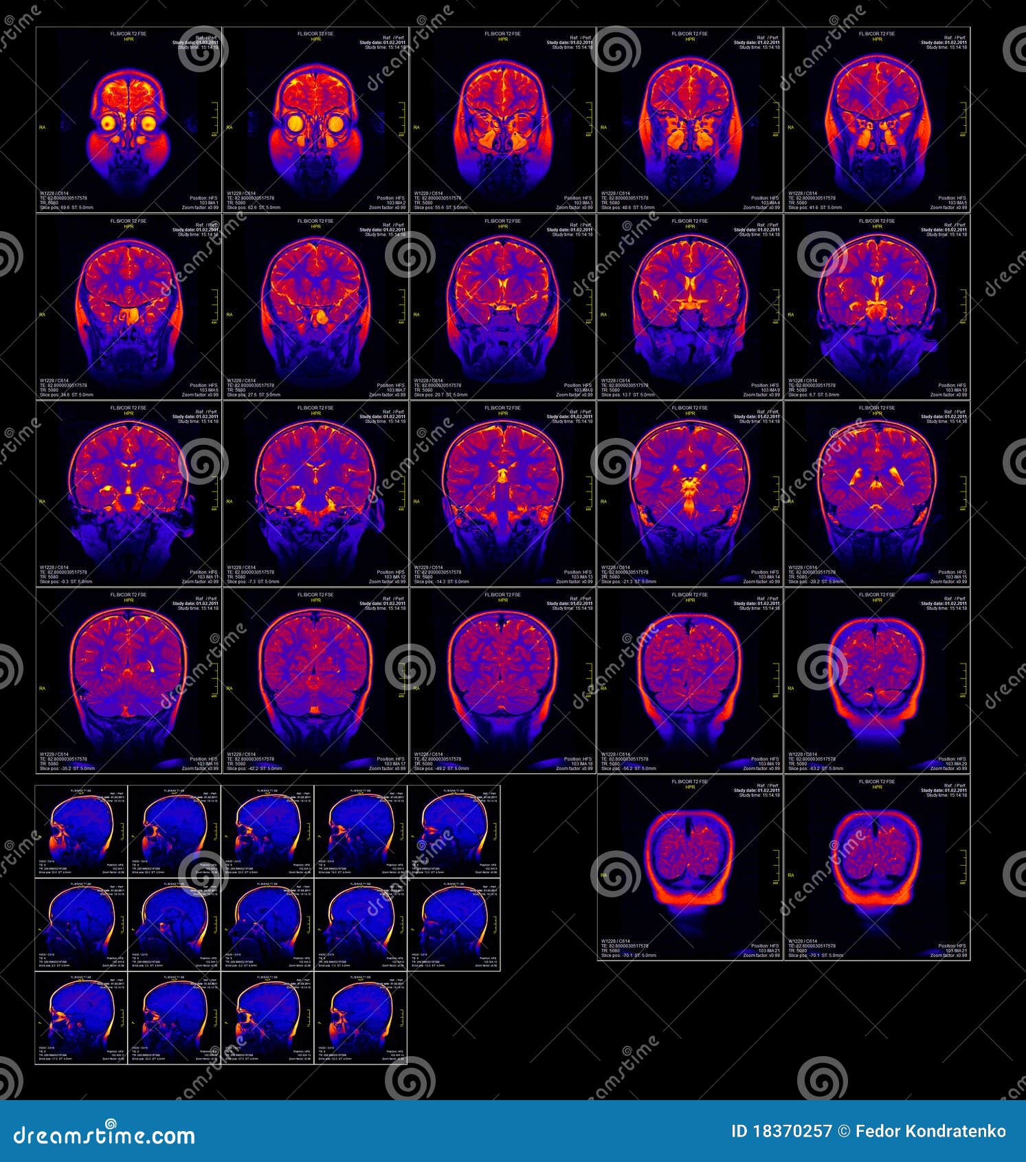 Real Brain MRI Slide of a Girl Stock Illustration - Illustration of ...