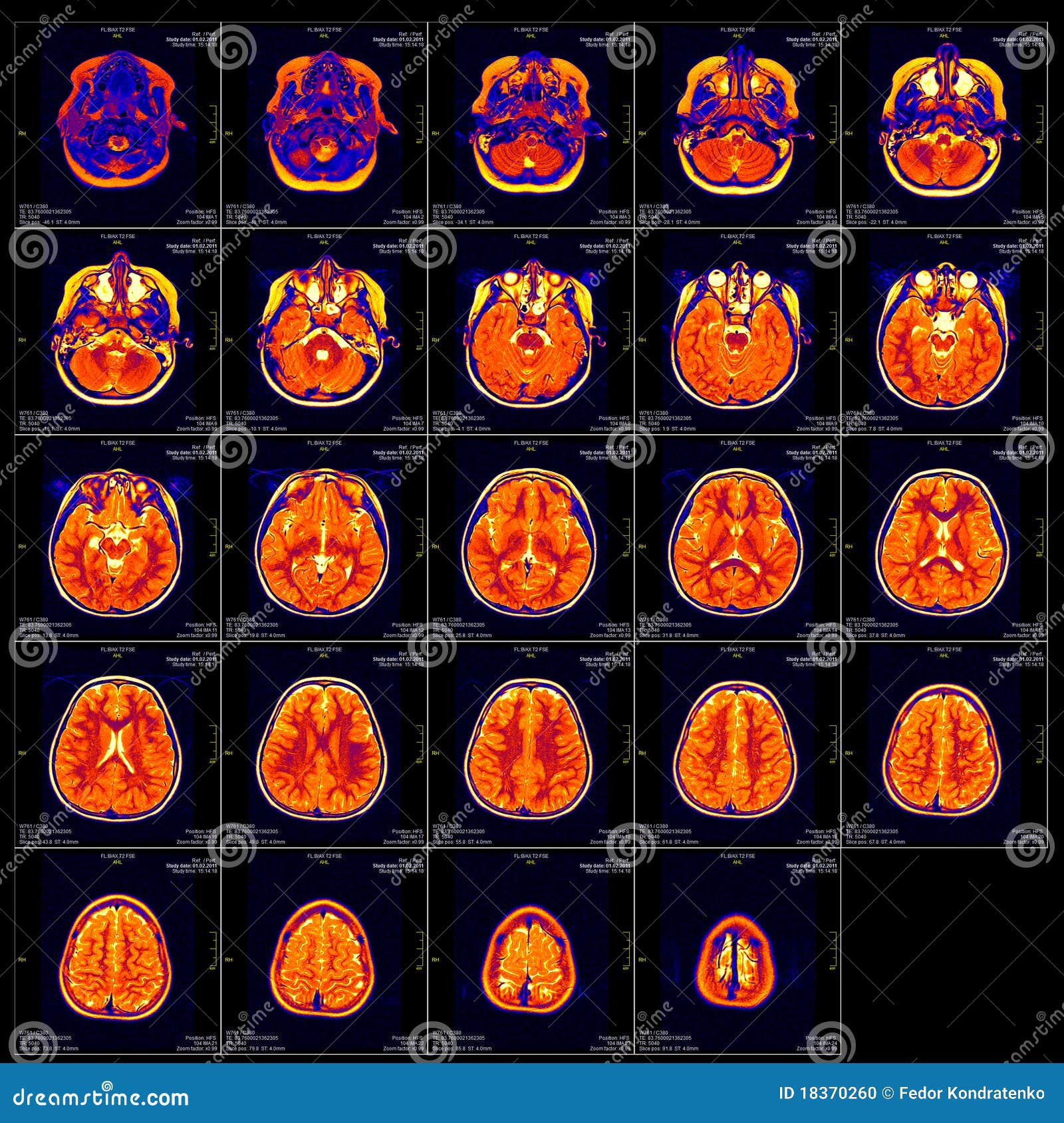 Real Brain MRI Slide of a Girl Stock Photo - Image of ambulance ...