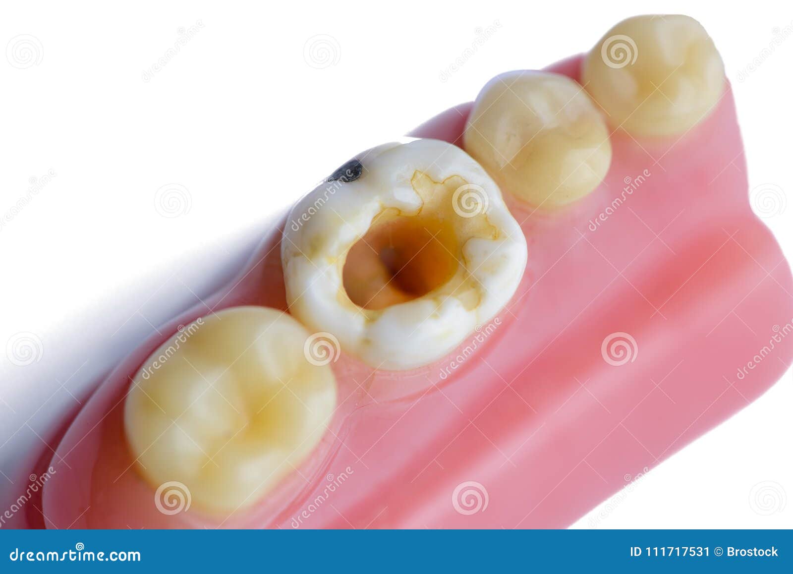 Real Decay Molar Teeth Model Stock Image - Image of structure, model ...