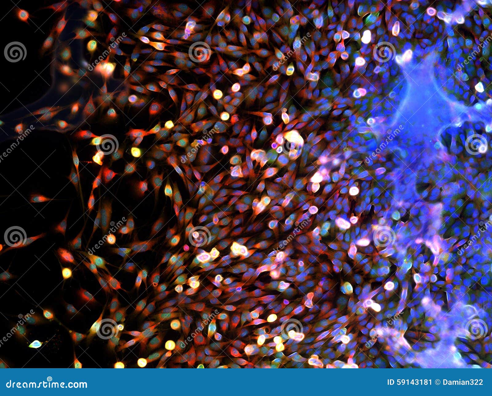 Real Fluorescence Microscopic View of Cancer Cells - Human Brain Stock ...