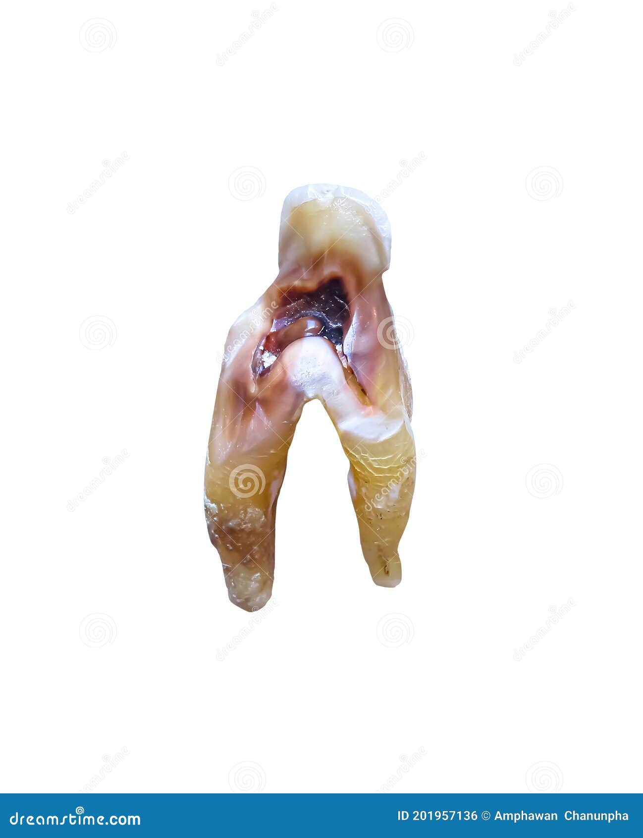 Real Human Tooth with Caries Isolated on White Background , Clipping ...