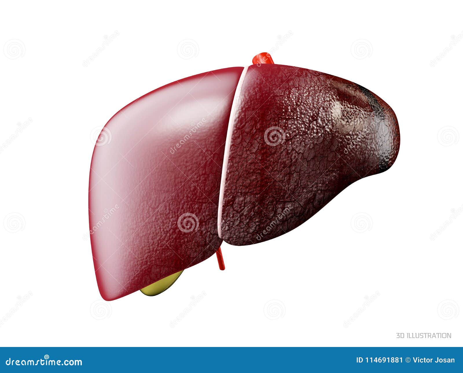 Realistic 3d Illustration of Comparsion of Healthy and Sick Cirrhosis ... Realistic 3d Illustration of Comparsion of Healthy and Sick Cirrhosis ...