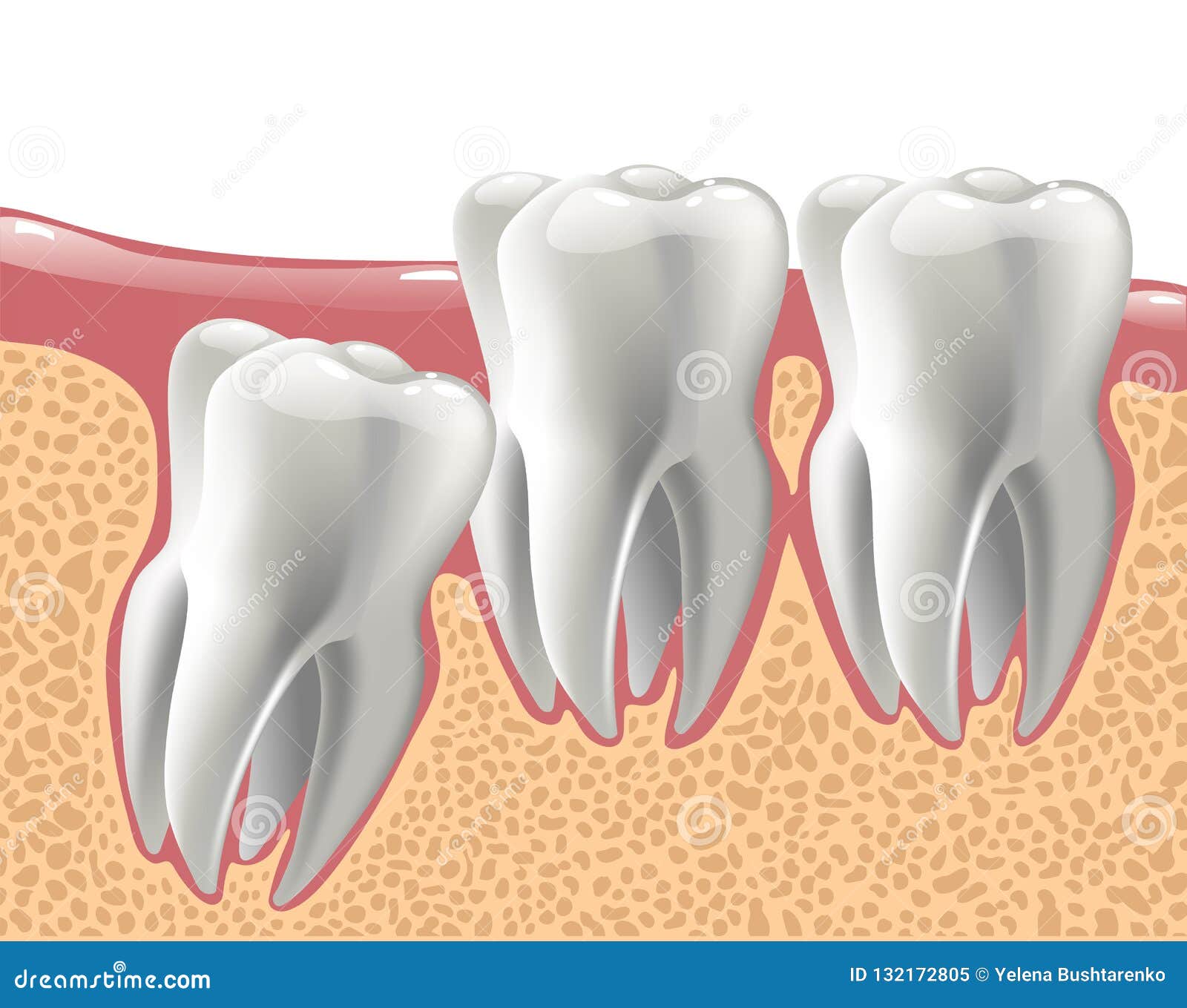 Wisdom Tooth With Impaction At Molar Tooth. Medically Accurate Tooth ...