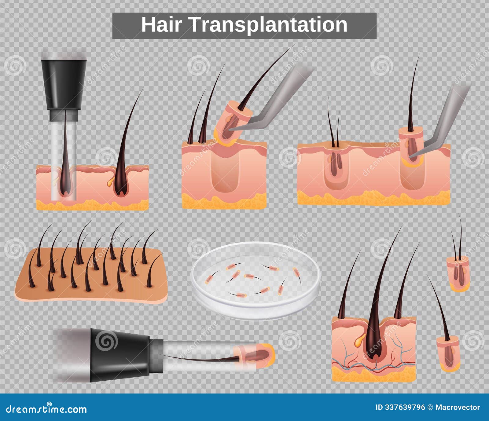 Hair Transplantation Infographics Of Male Alopecia Treatment Vector ...