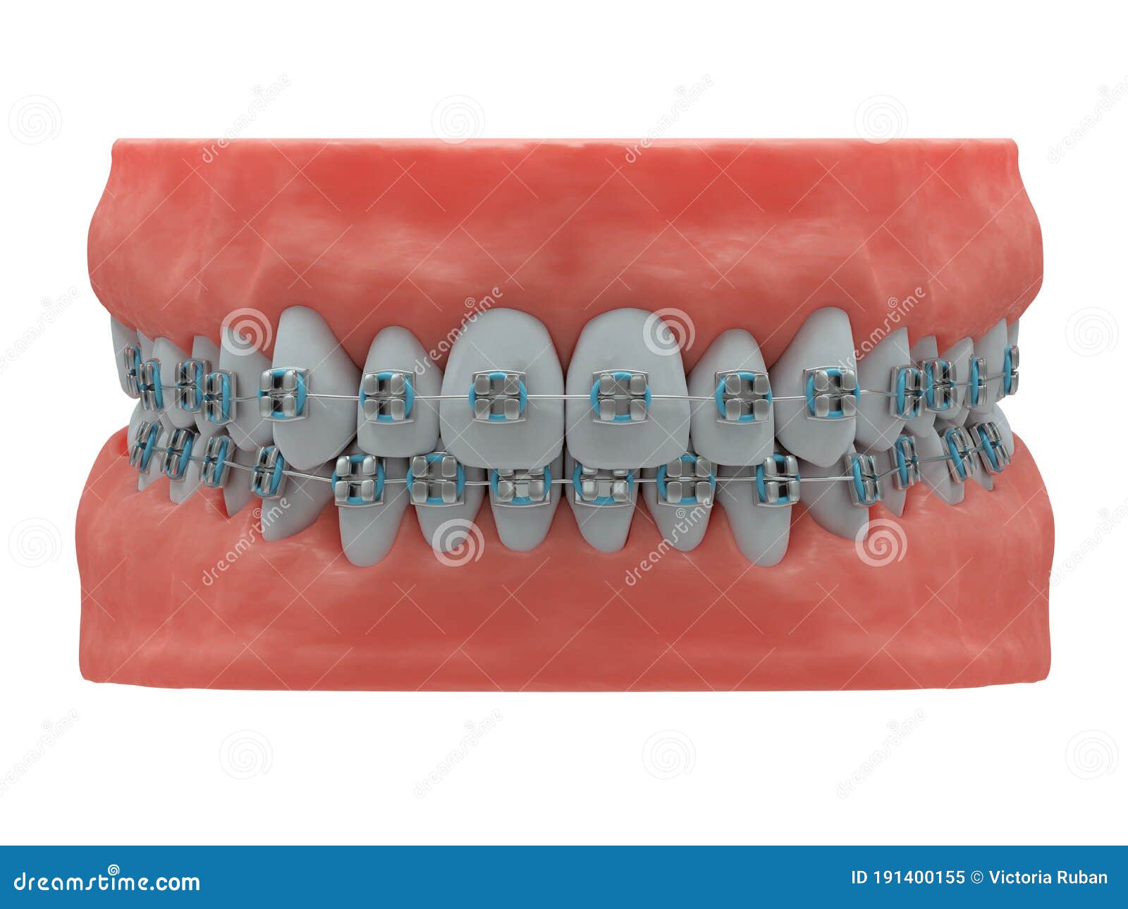 Classic Metal Braces, Front View Stock Illustration - Illustration of ...