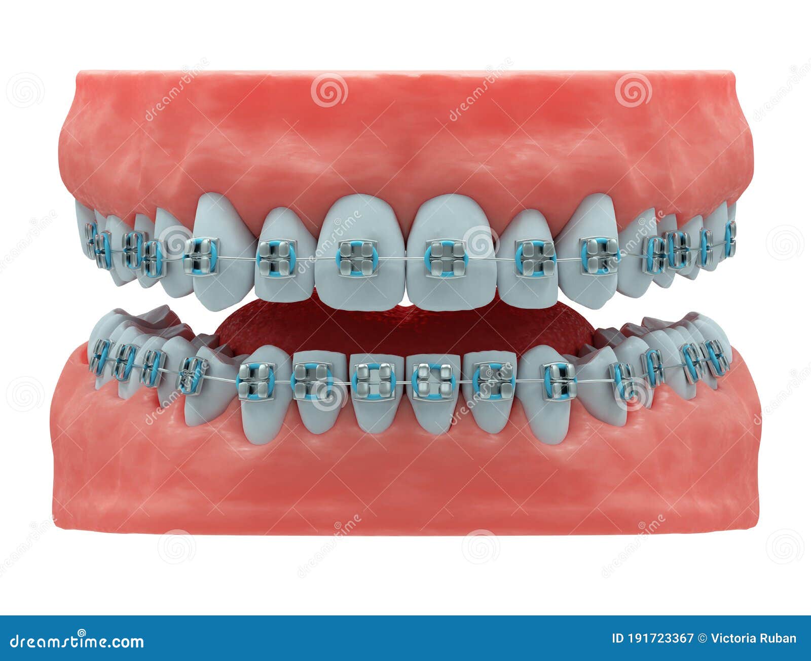 Healthy Teeth and Classic Metal Braces, Front View Stock Illustration ...