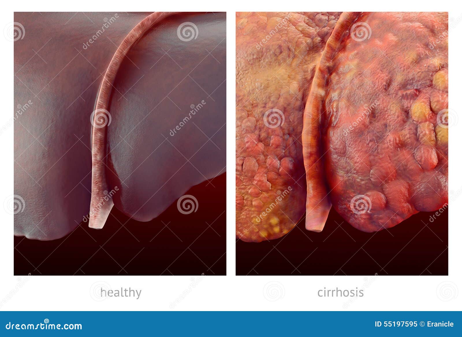 Realistic Illustration of Healthy and Sick Human Livers Stock Image ... Realistic Illustration of Healthy and Sick Human Livers Stock Image ...