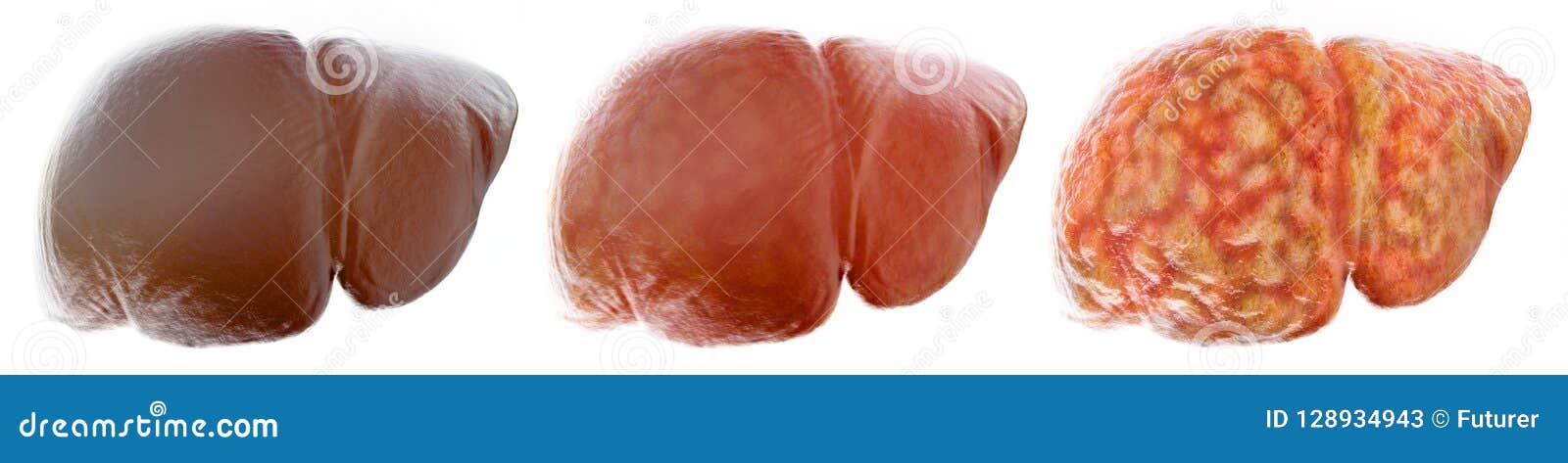 Realistic Stages of a Fatty Liver - 3D Rendering Stock Image - Image of ...
