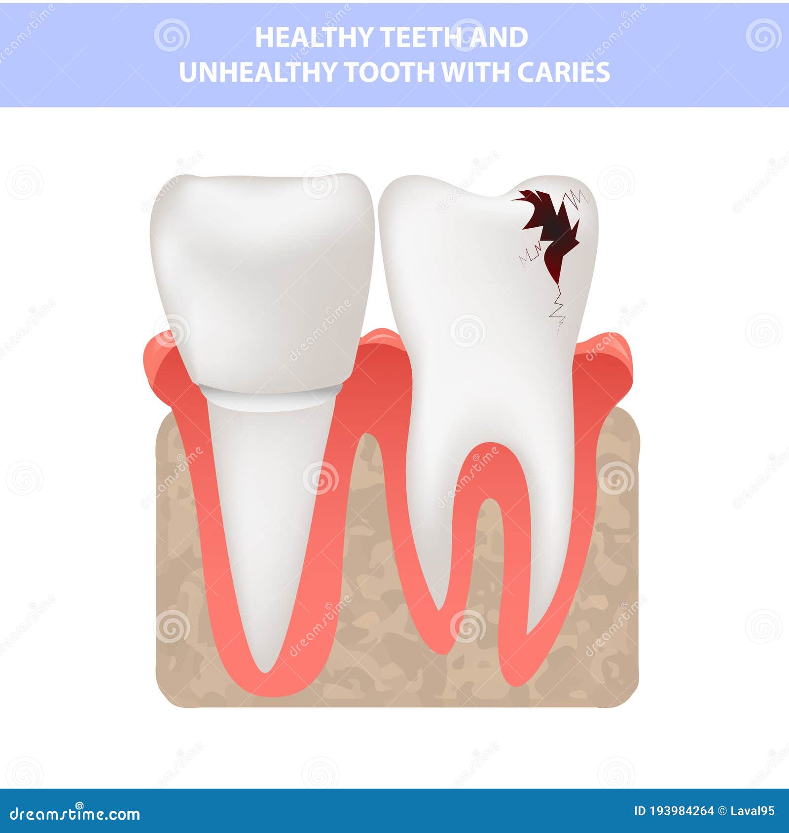 Realistic Teeth, Healthy Teeth and Caries, Gum Cross Section, Vector ...