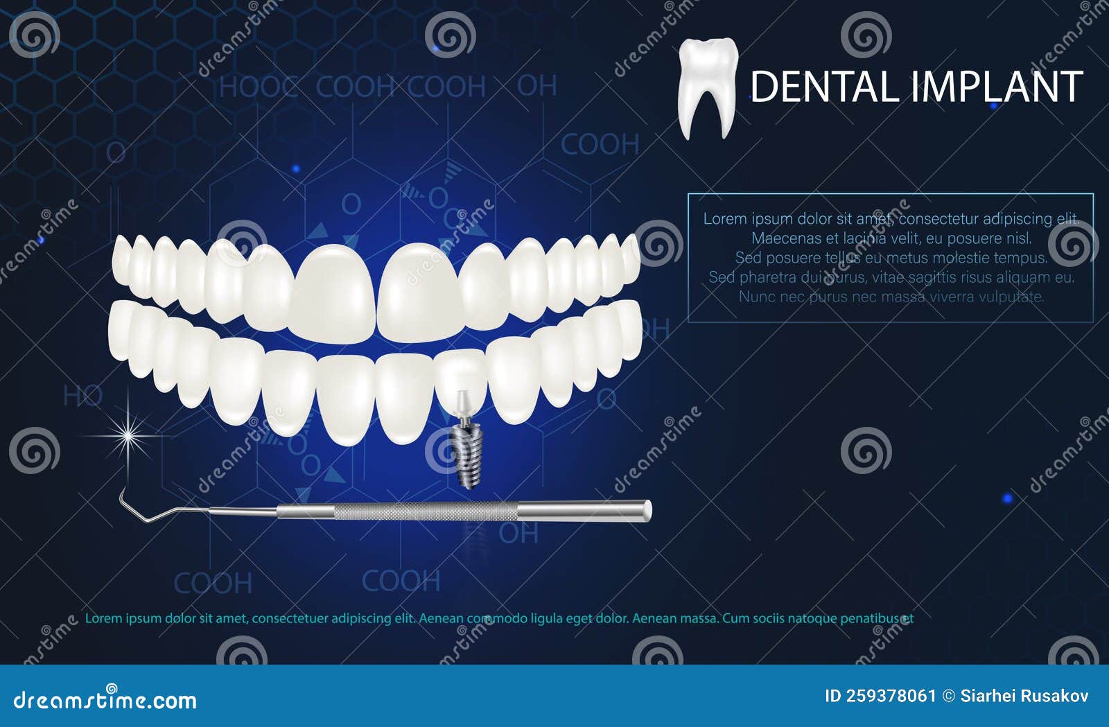 Realistic White Dental Implant on a Blue Background. Vector 3d Model of ...