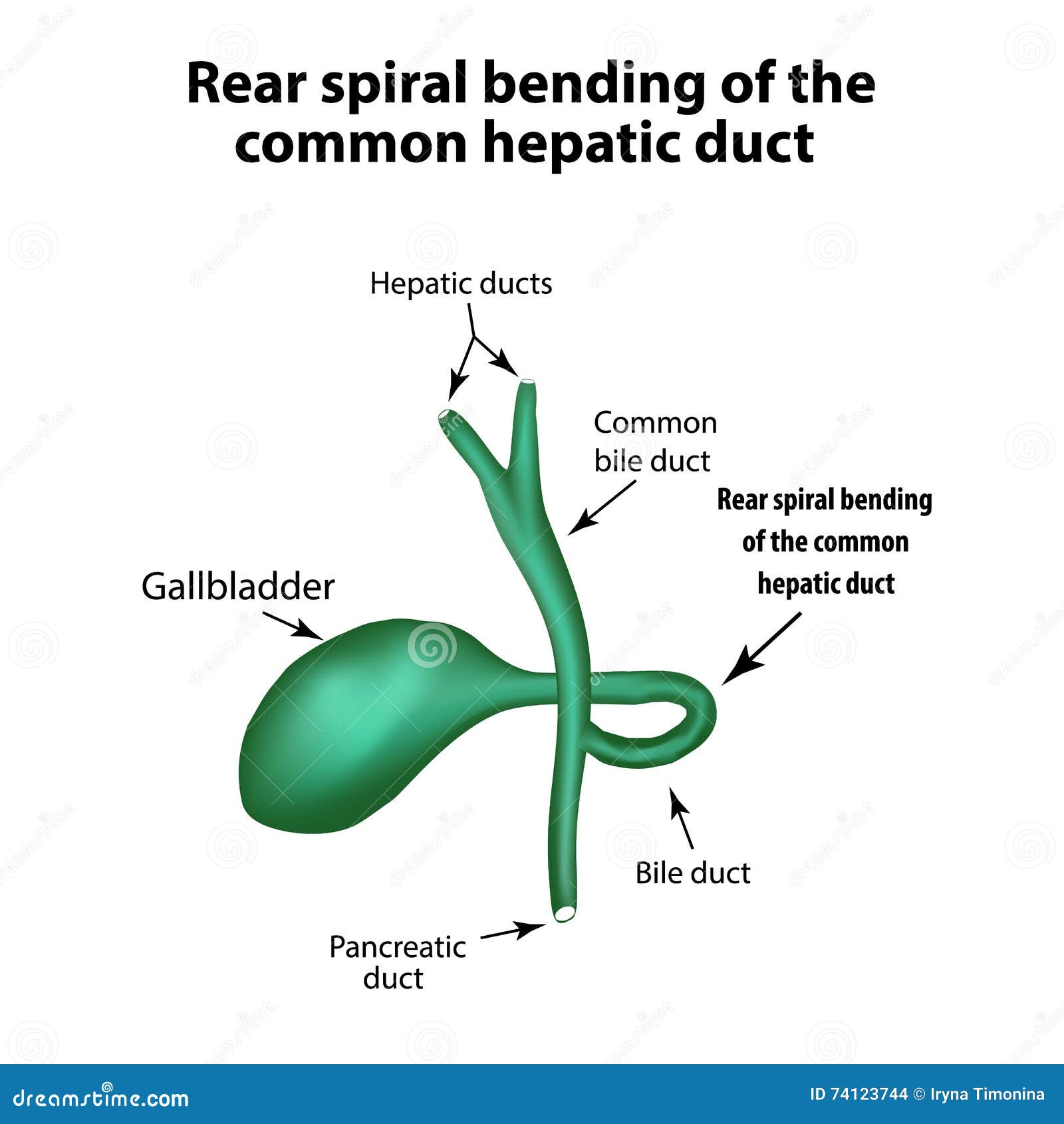 Rear Spiral Bending Of The Common Hepatic Duct. Pathology Of The ...