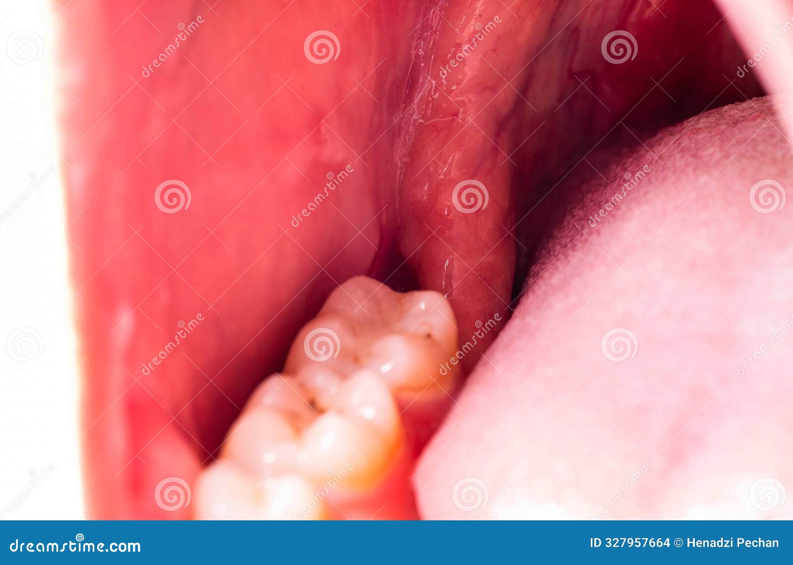 Recess after Complex Impacted Wisdom Tooth Extraction, Traumatic ...