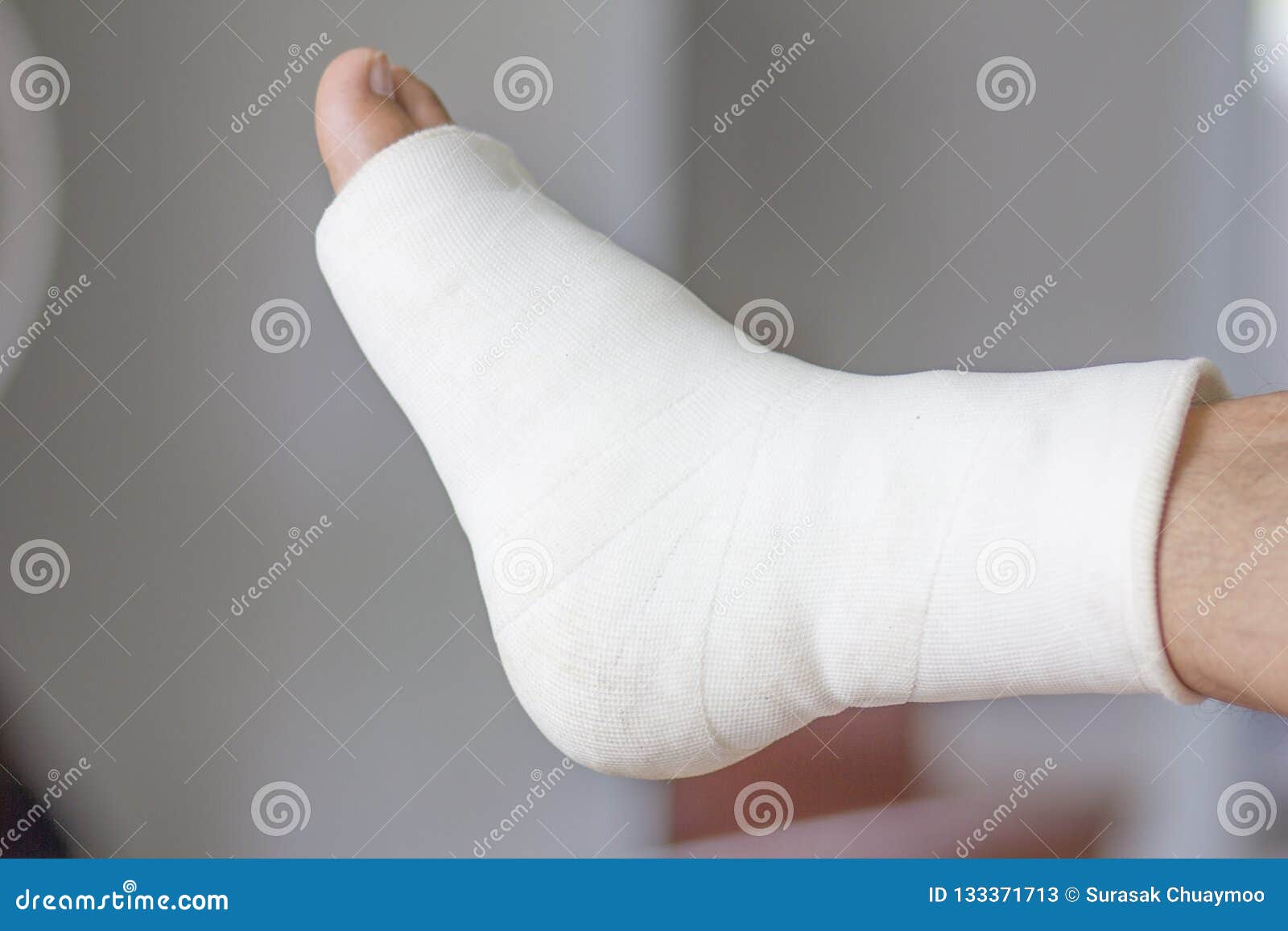 Broken ankle stock image. Image of ankle, broken, recovering - 133371713