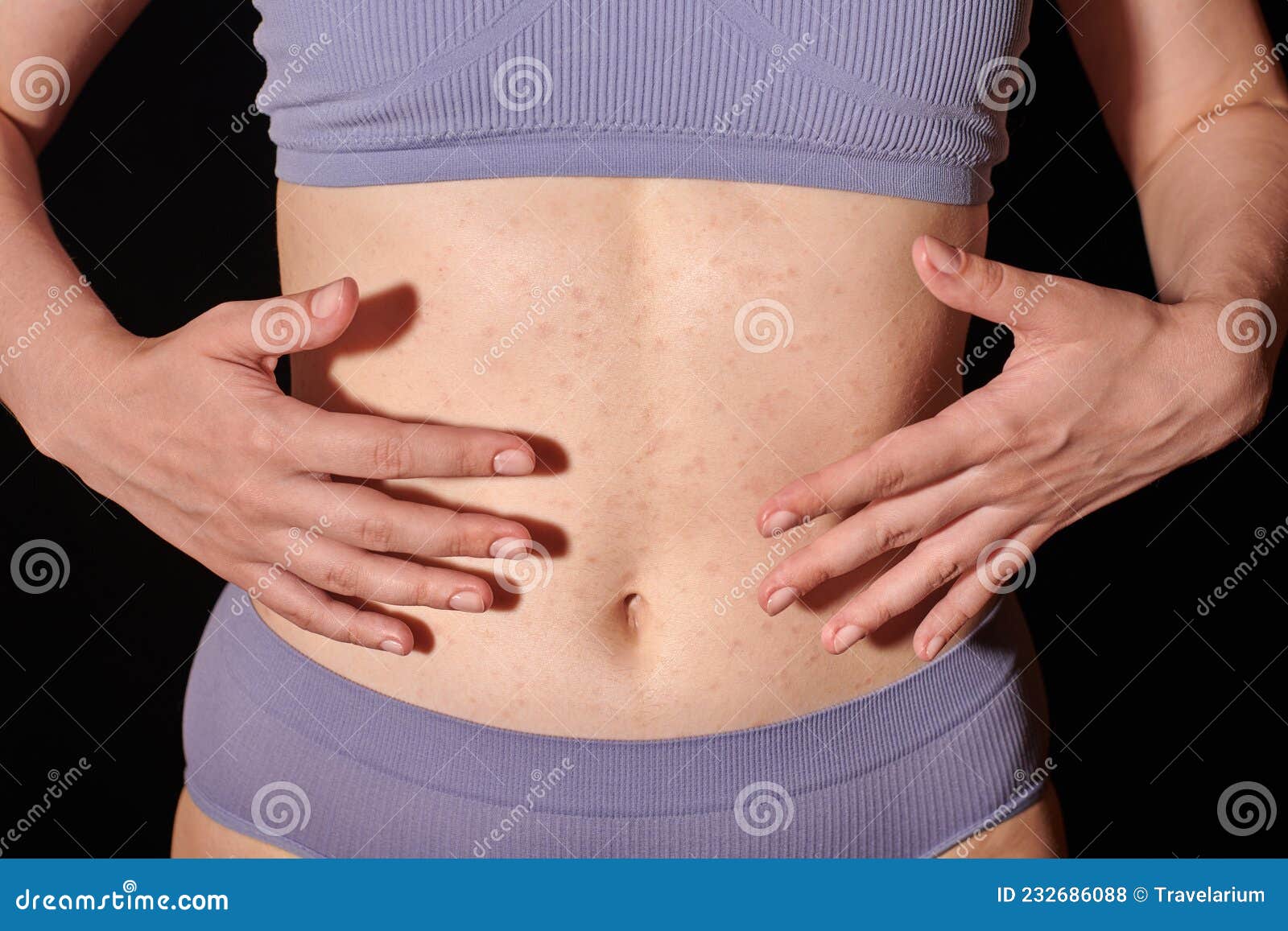 Red Allergic Rash On Stomach Skin Skin Allergy Atopic Dermatitis Eczema Woman Applying
