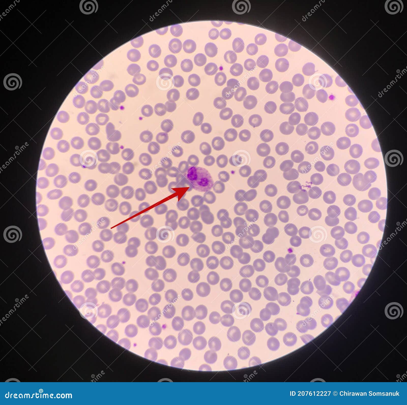 Red Arrow Showing Neutrophil with Toxic Granule Stock Image - Image of ...
