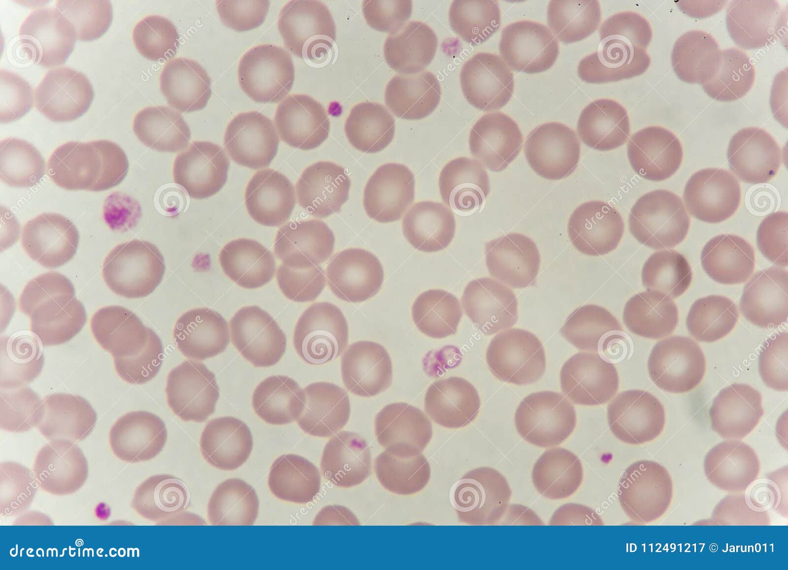 Red Blood Cells in Blood Smear Stock Image - Image of leukemia, iron ...