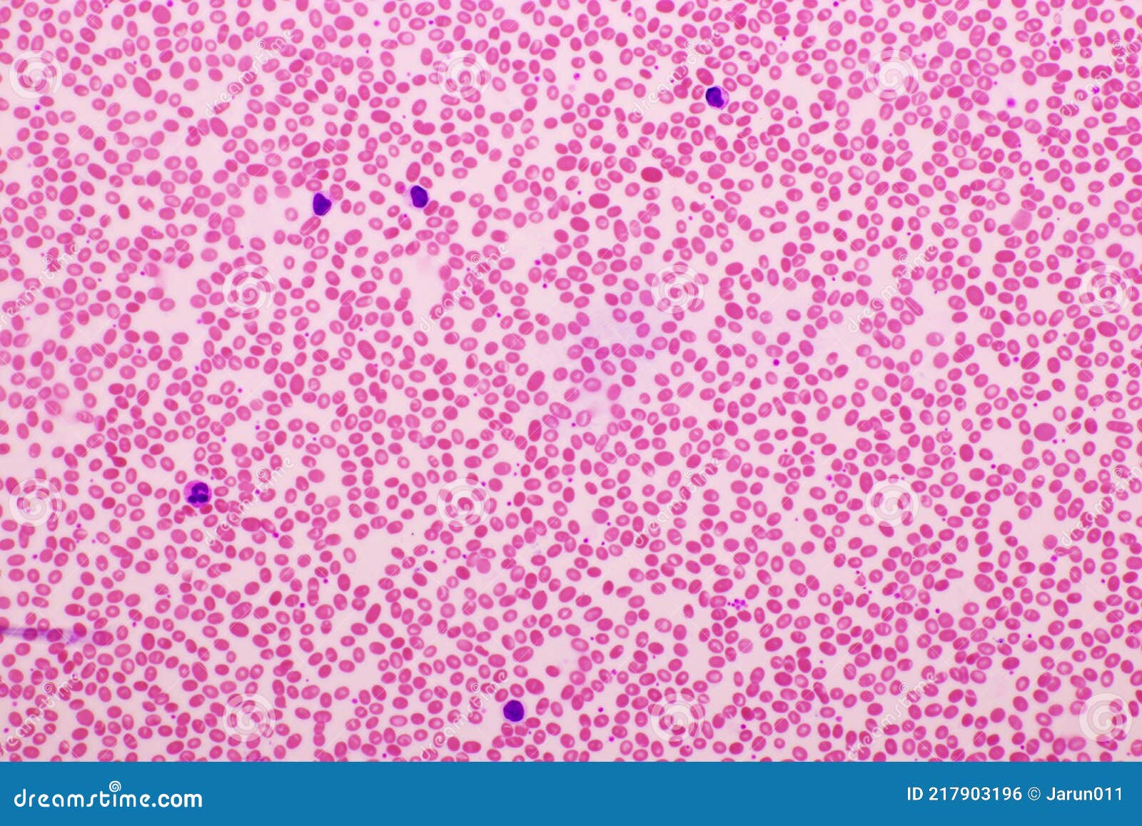 Red Blood Cells in Blood Smear Stock Photo - Image of acanthocyte ...