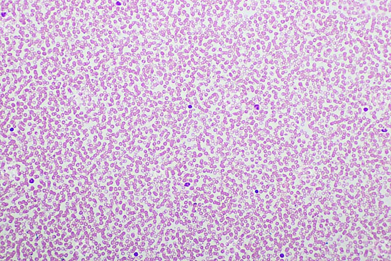 Red Blood Cells and White Blood Cells in Blood Smear Stock Image ...