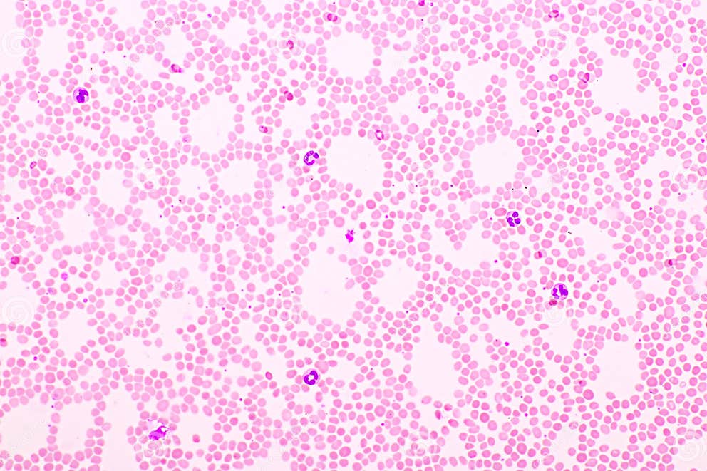 Red Blood Cells and White Blood Cells in Blood Smear Stock Photo ...