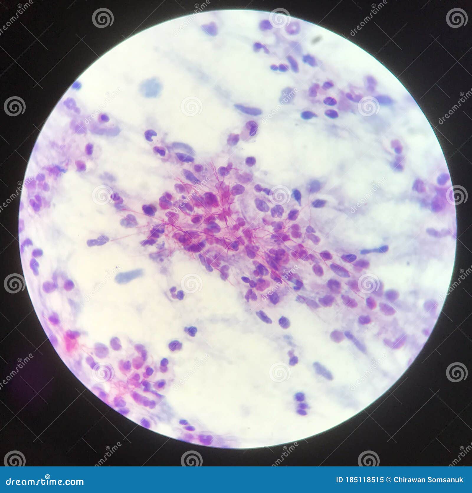 Red Branching Mycobacterium Tuberculosis on Blue Background in Modified ...