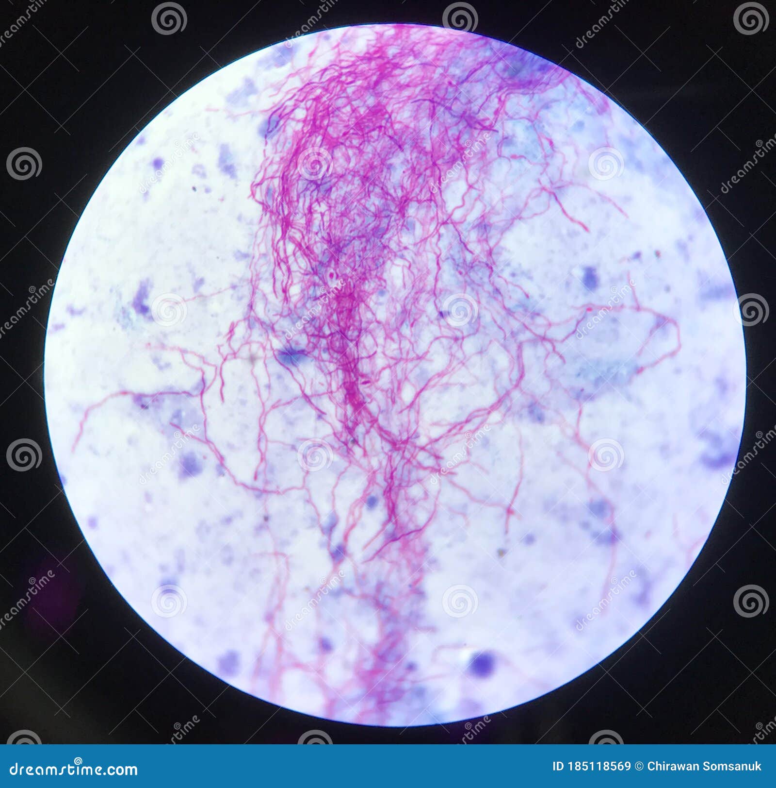 Mycobacterium Tuberculosis Acid Fast Stain