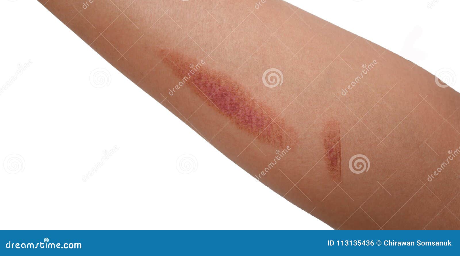 Burn wound on skin. stock photo. Image of skin, scar - 113135436