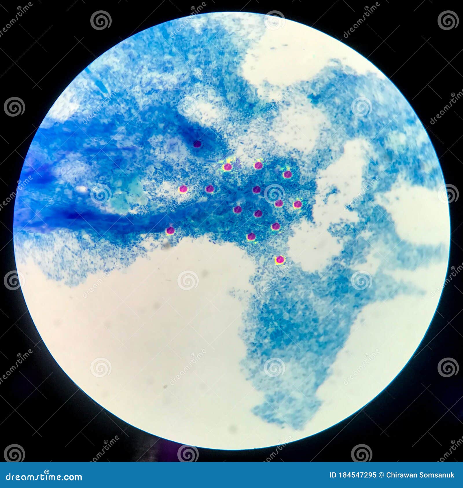 Red Cell on Blue Background Cryptococcus in HIV Patients Stock Image ...
