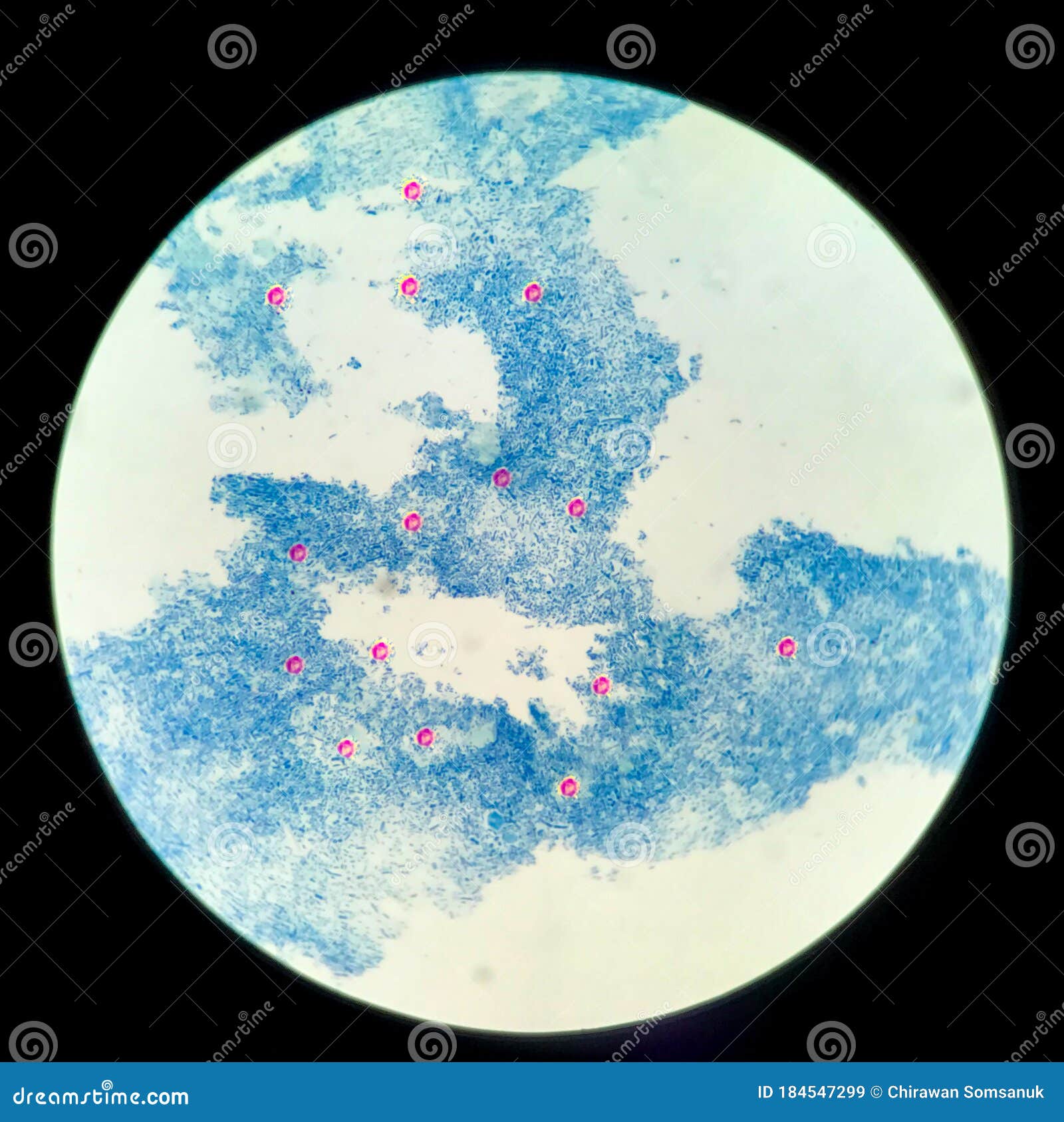 Red Cell on Blue Background Cryptococcus in HIV Patients Stock Image ...