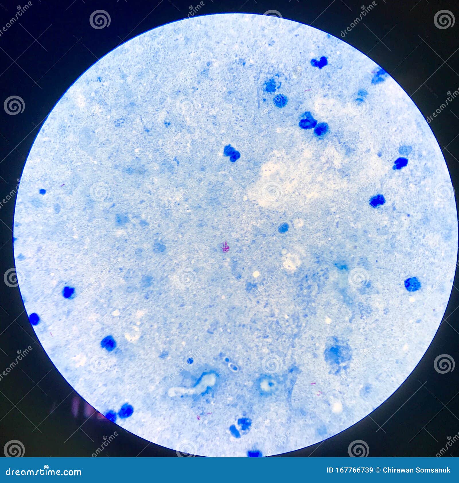 Red Cells on Blue Background Tuberculosis Stock Image - Image of ...