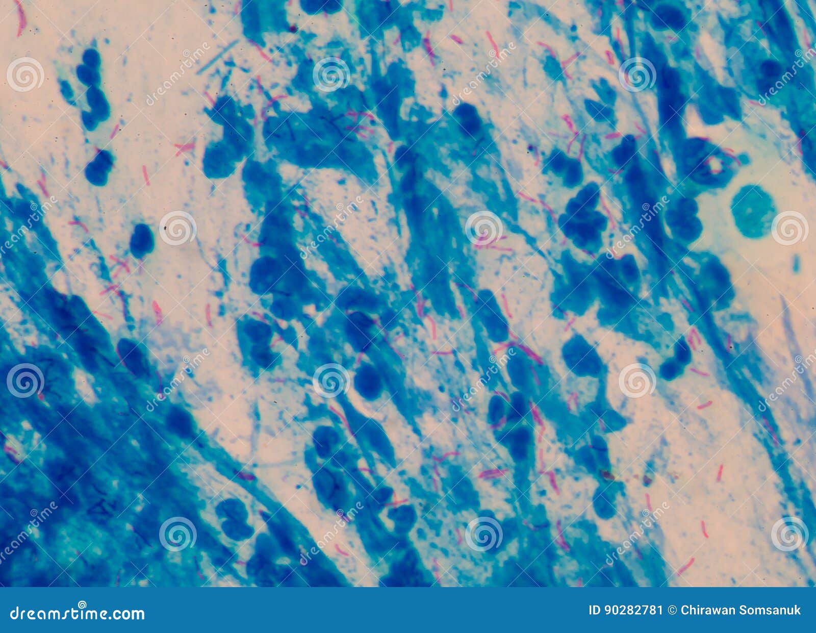 Red Cells Microbacterium Tuberculosis Stock Image - Image of lung ...