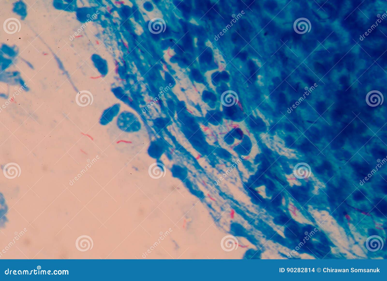 Red Cells Microbacterium Tuberculosis Stock Photo - Image of bacterium ...