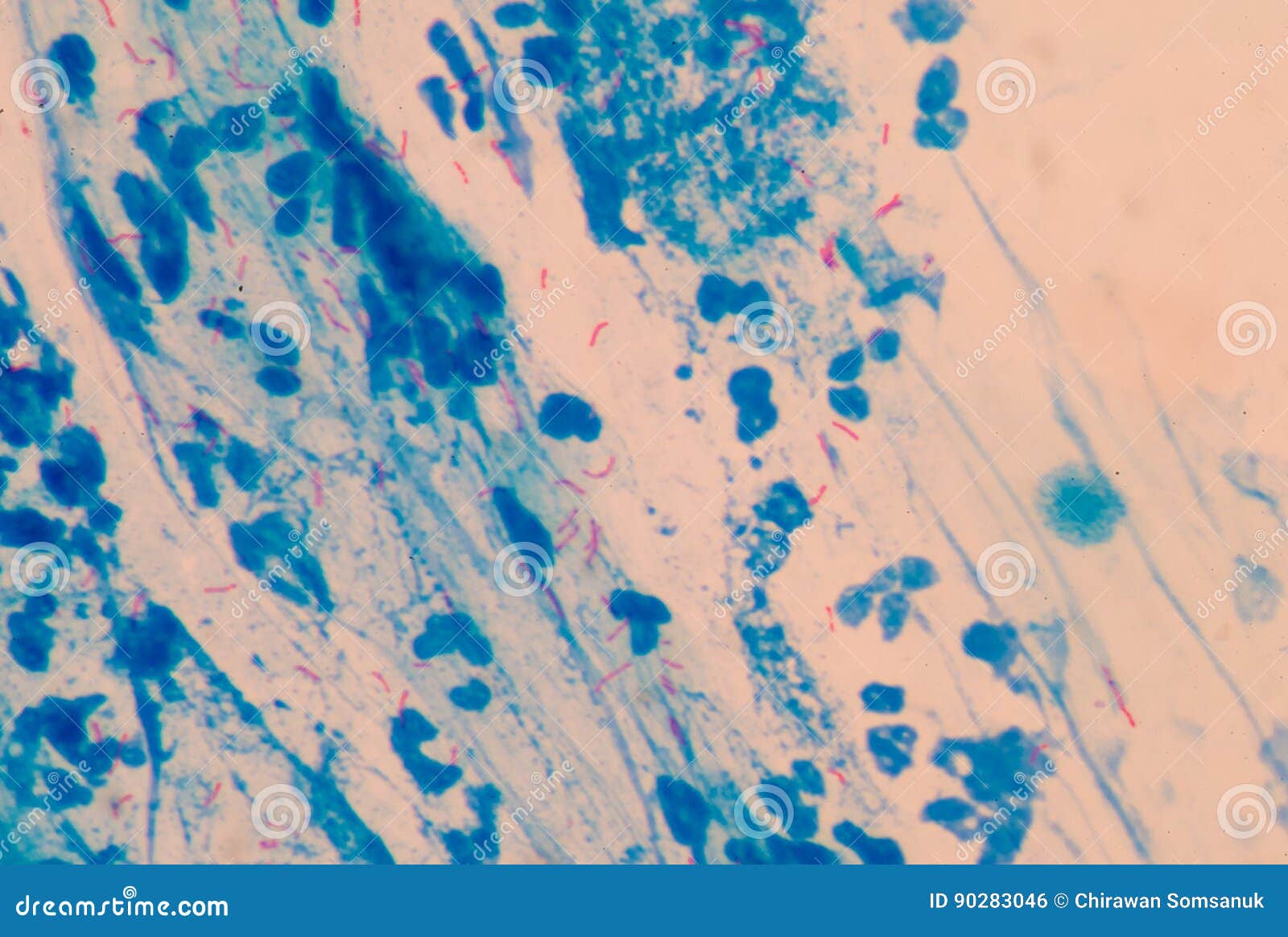 Red Cells Microbacterium Tuberculosis Stock Photo - Image of bacterium ...