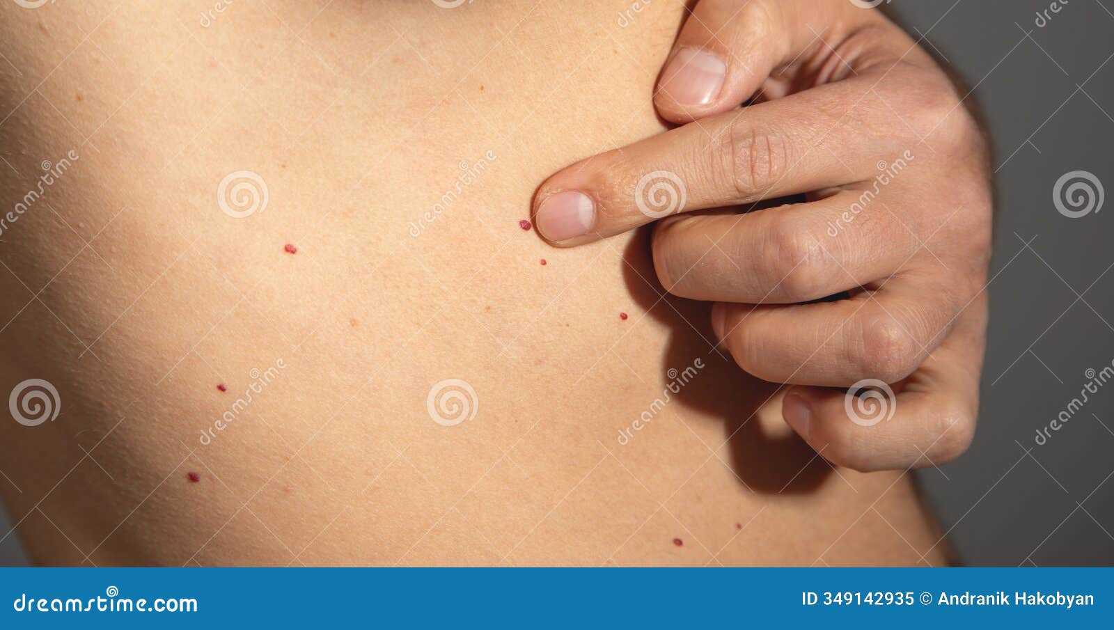 Red dots on the human body stock image. Image of lesion - 349142935