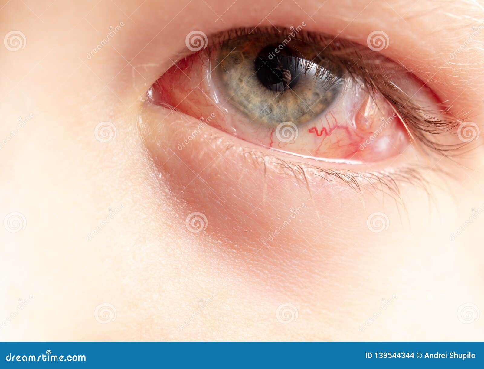 Red Eye on Face after Surgery Stock Photo - Image of blind, closeup ...