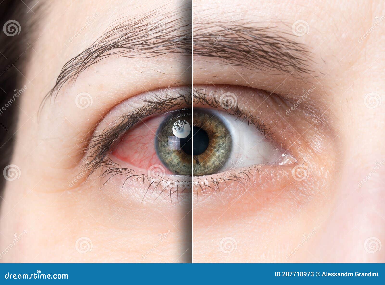 Red Eye before and after Treatment Stock Image - Image of ...