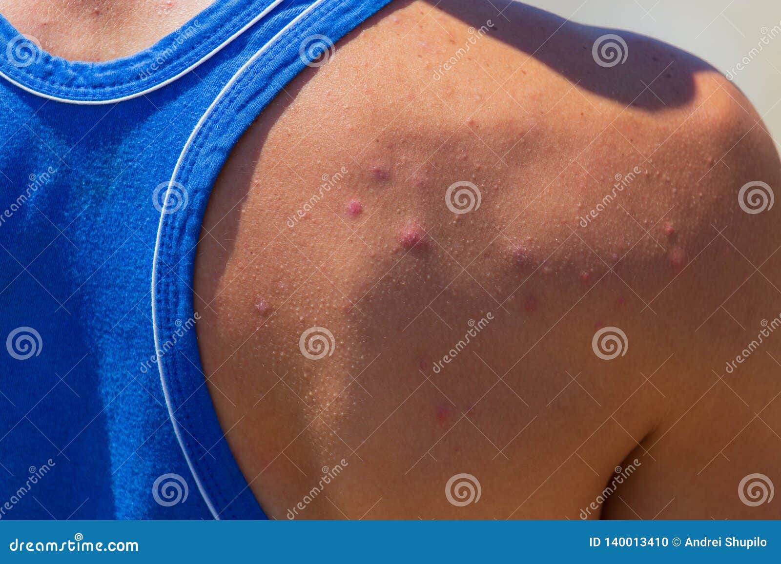 Red pimples on male skin stock photo. Image of macro - 140013410